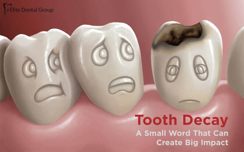 Cavities and tooth decay - Symptoms and causes