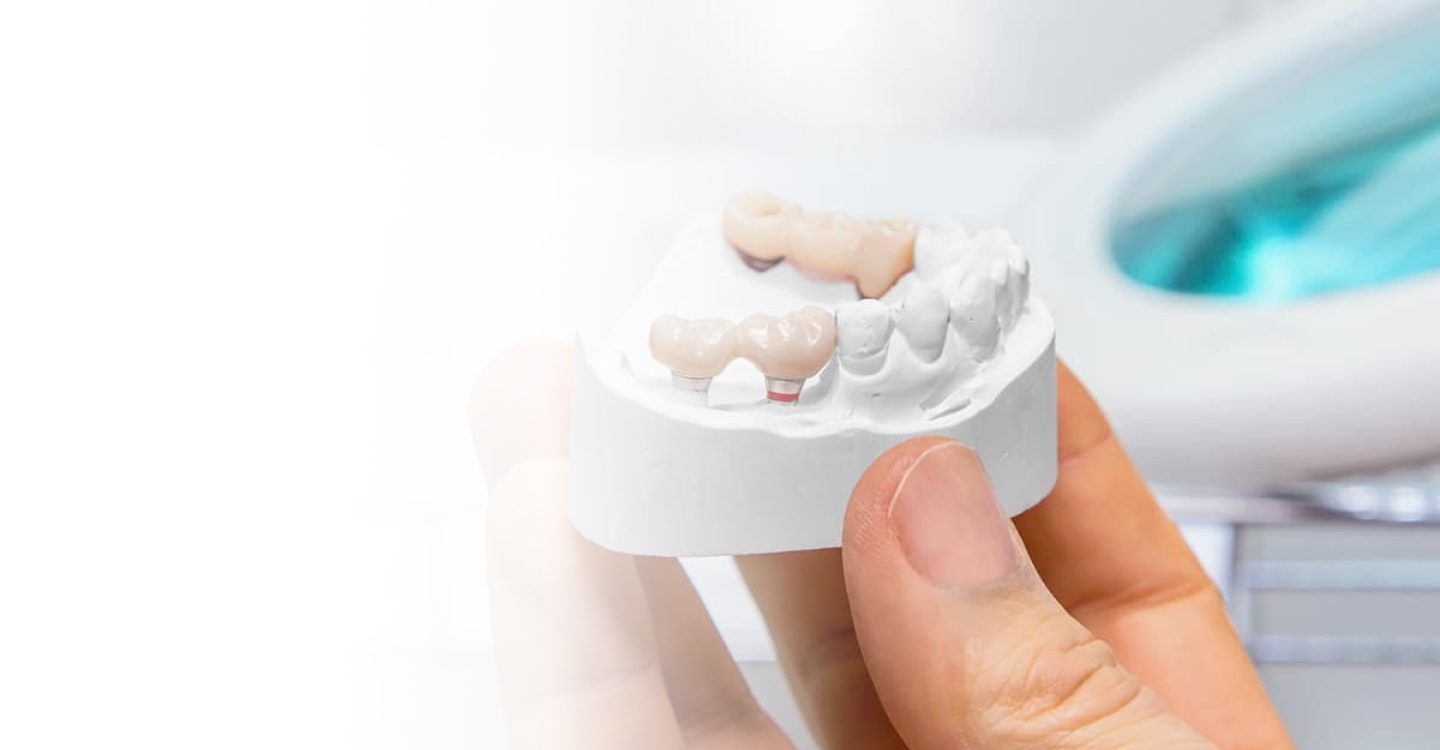 About Bridges - Elite Dental Group