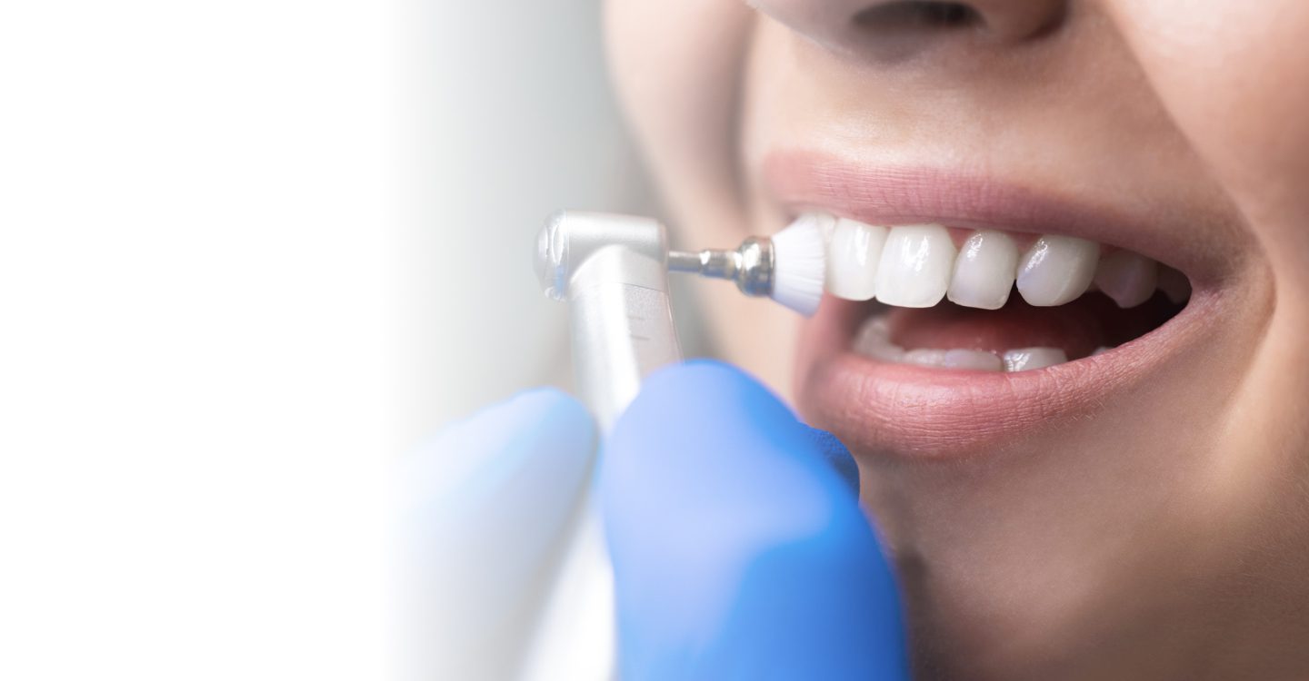 Deep Cleaning / Scaling and Root Planning