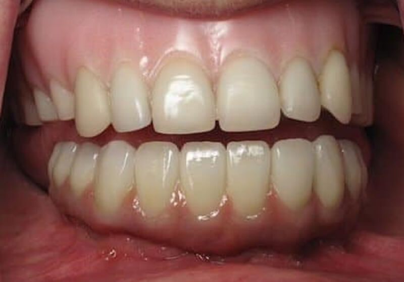 Front Flipper Dental A Detailed Description About The Dental Flippers